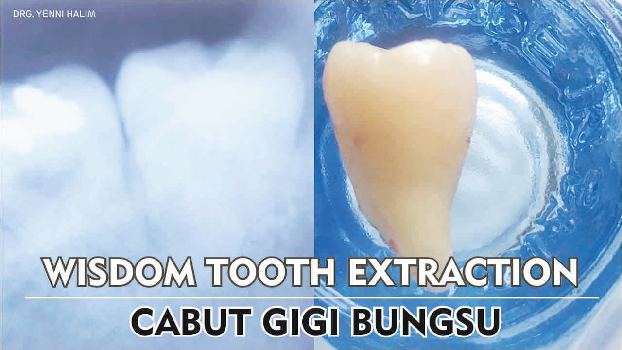 WISDOM TOOTH EXTRACTION | CABUT GIGI BUNGSU - YouTube