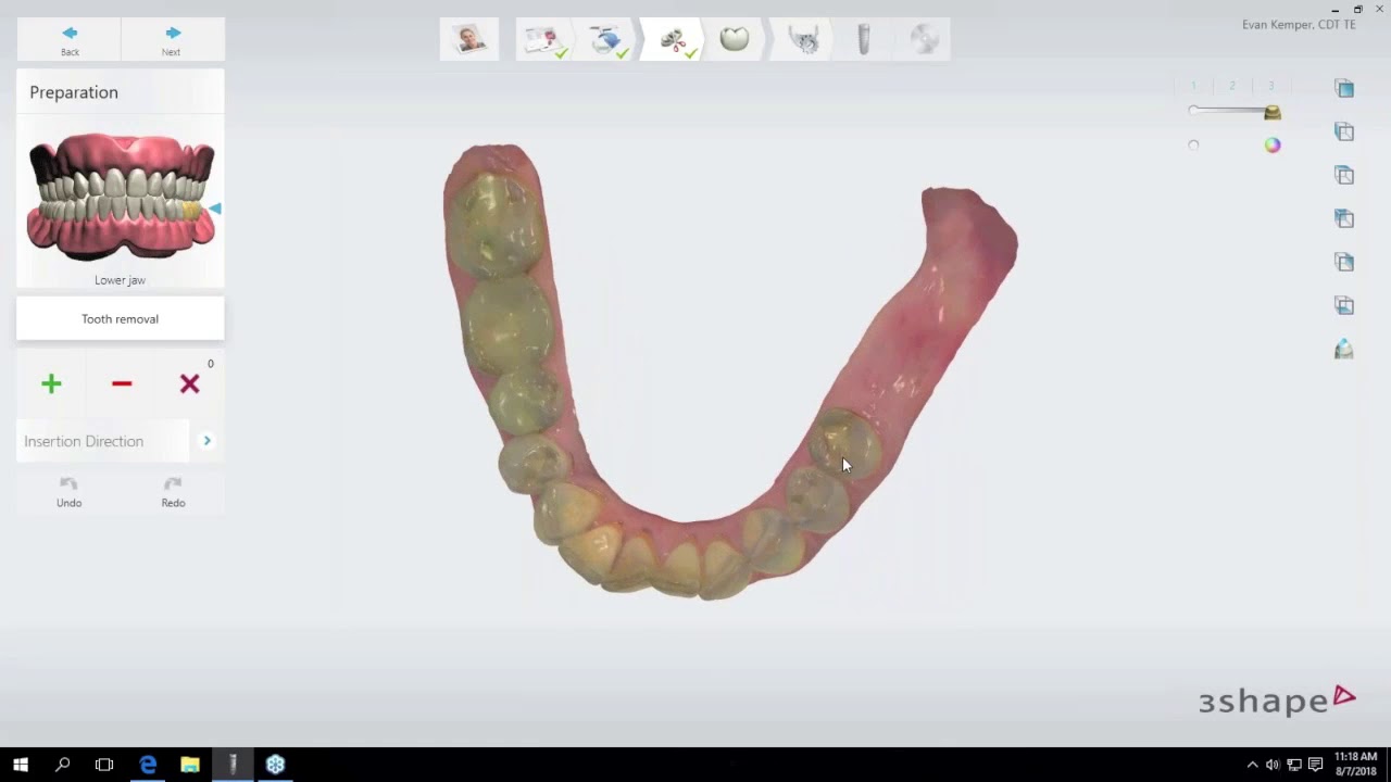[Webinar] 3Shape Implant Studio 101: Introduction to 3Shape Implant ...