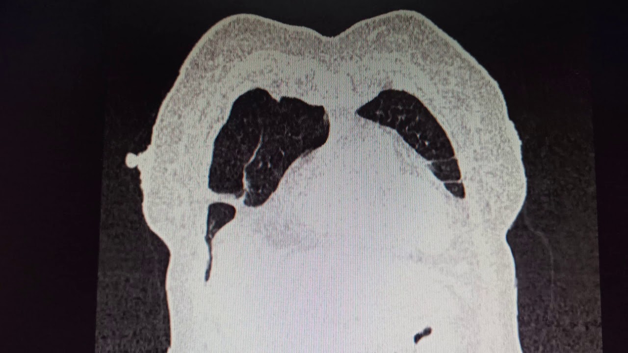 Multiple cavitary lesions with surrounding consolidation and ground ...