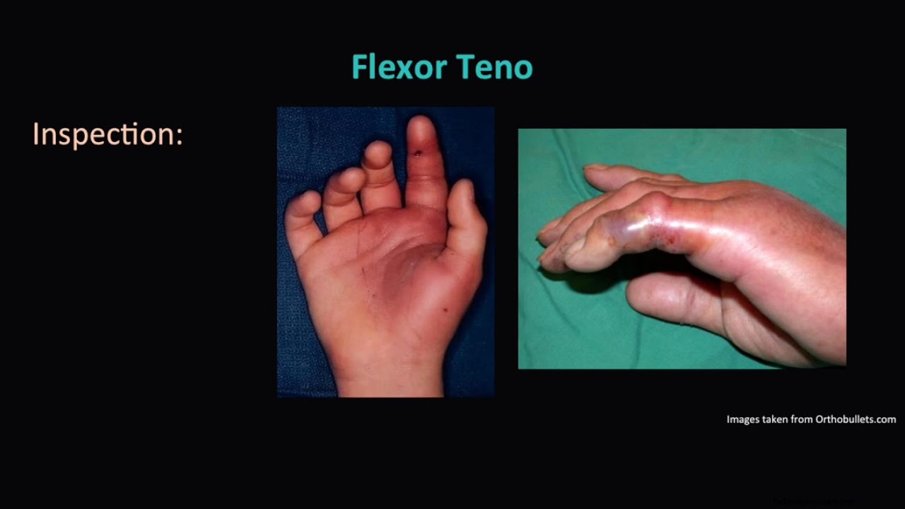 Flexor Tenosynovitis - YouTube