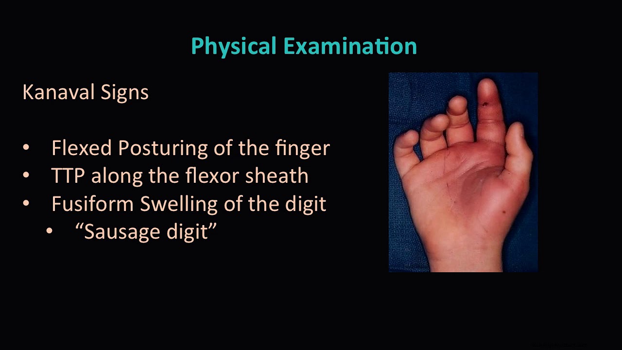 Flexor Tenosynovitis - YouTube