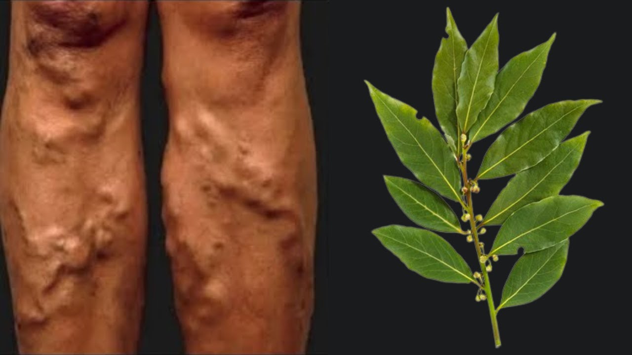 Elimine VARIZES e DORES NAS ARTICULAÇÕES com folha de louro - YouTube