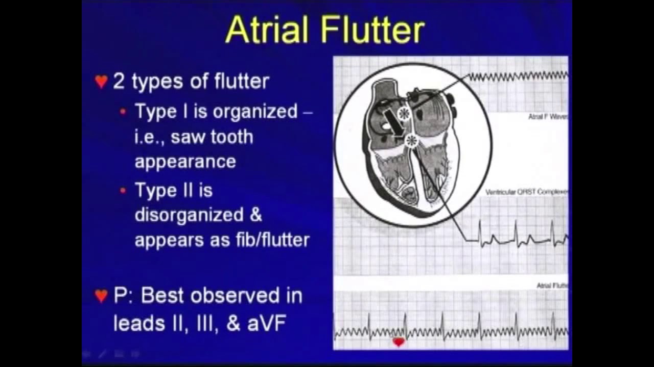 4.3.a. Atrial Flutter - Tachyarrhythmias [Hong Kong University] - YouTube