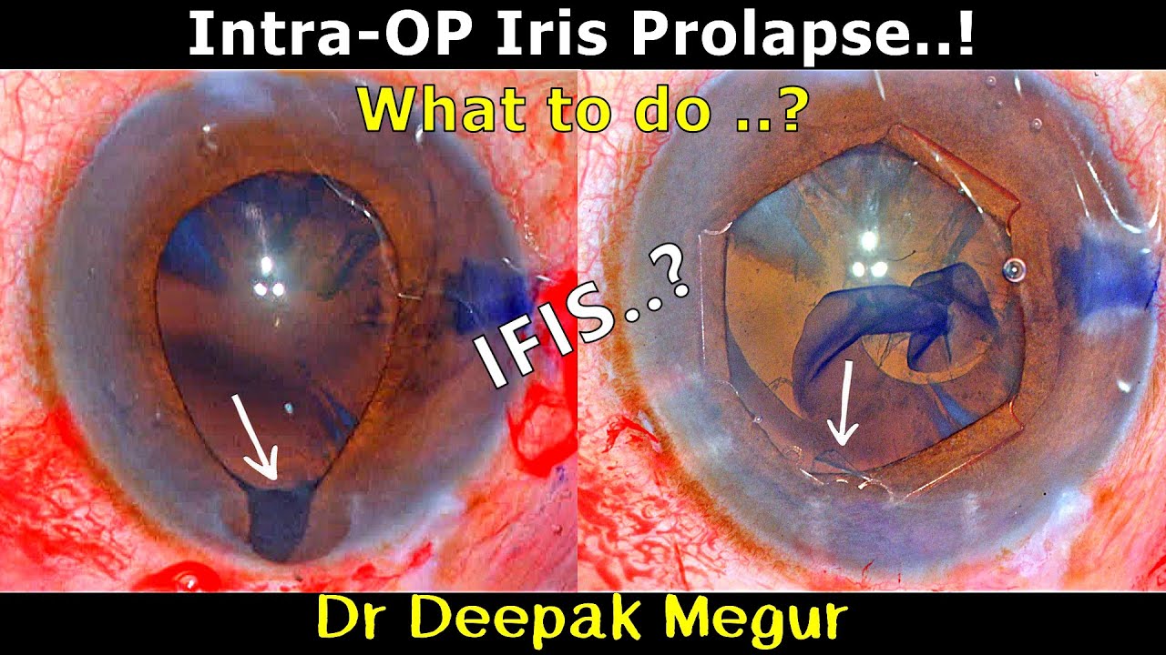 Intra-Operative Iris Prolapse- How to deal with it..? - YouTube