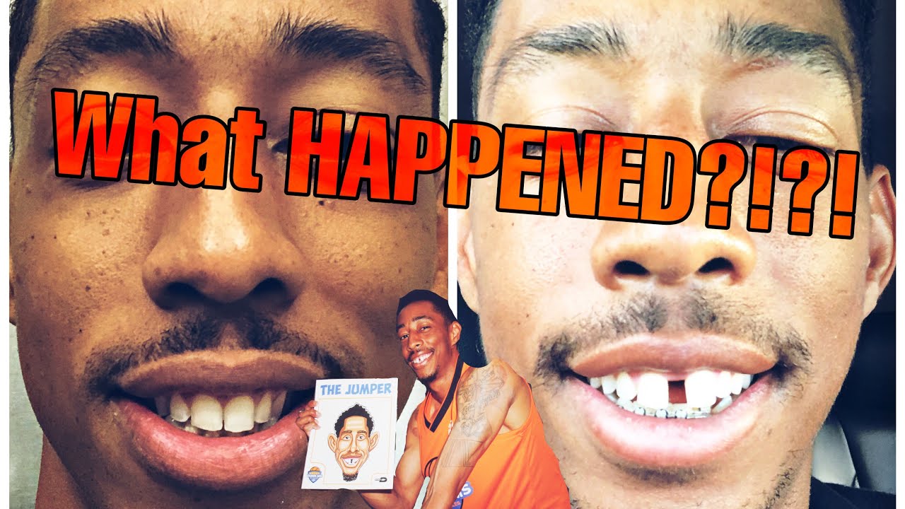 What Happened to Your teeth?! 7 weeks post SARPE Surgery - YouTube