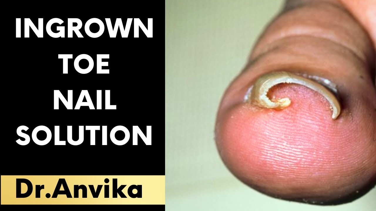 Ingrown Toe Nail Solution - Dr. Anvika - 9999 747 717 // 8287001211 ...