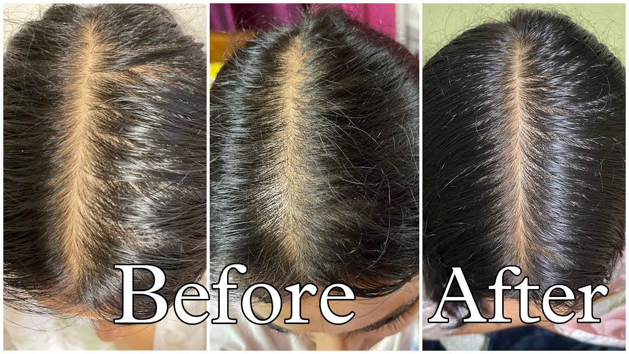 My Honest Hair loss Journey & How I fixed it - YouTube