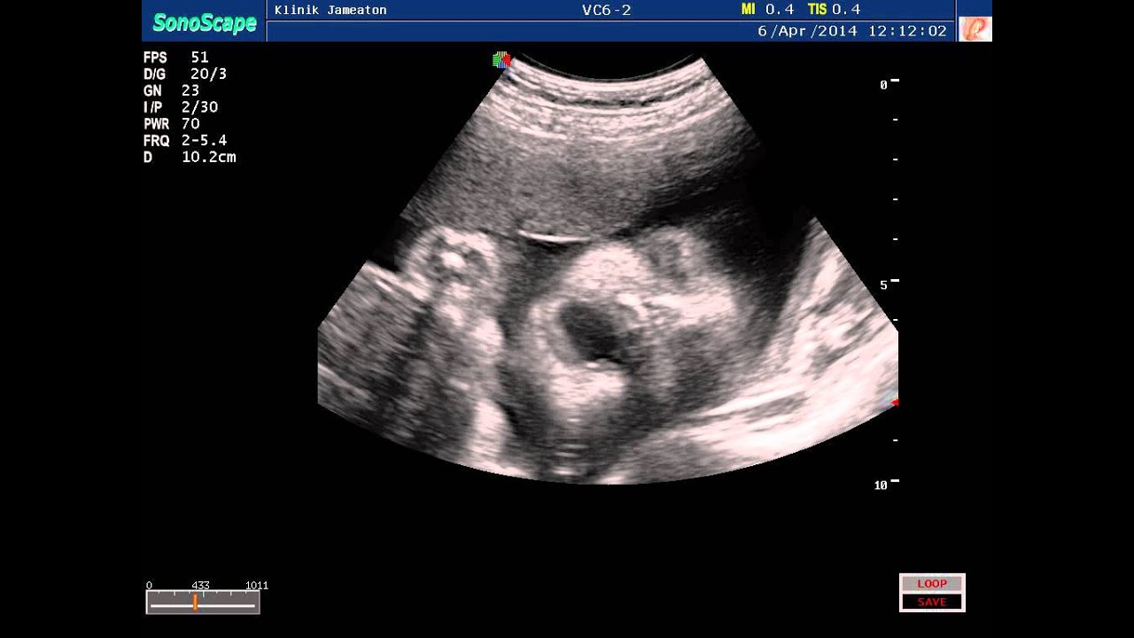 Melissa menguap masa scan ultrasound. - YouTube