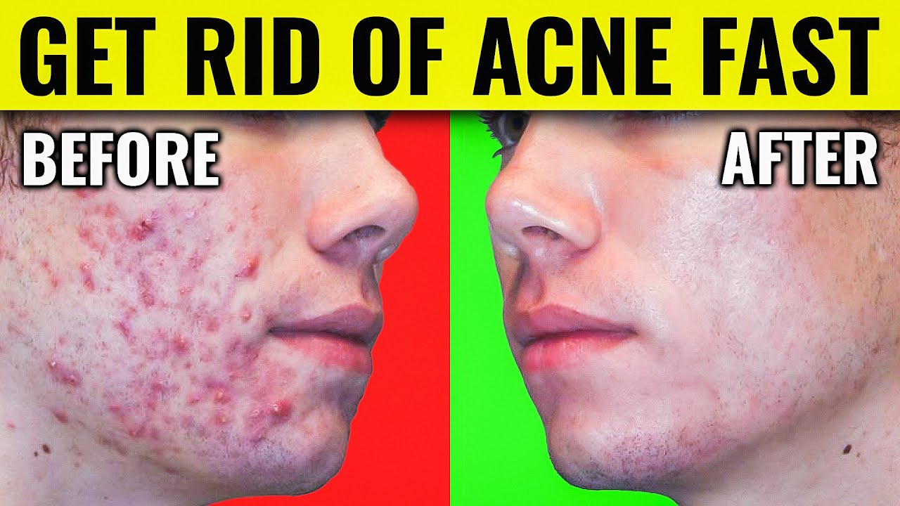 Say Goodbye To Acne Dr Bergs Proven Methods For Clearing Your Skin