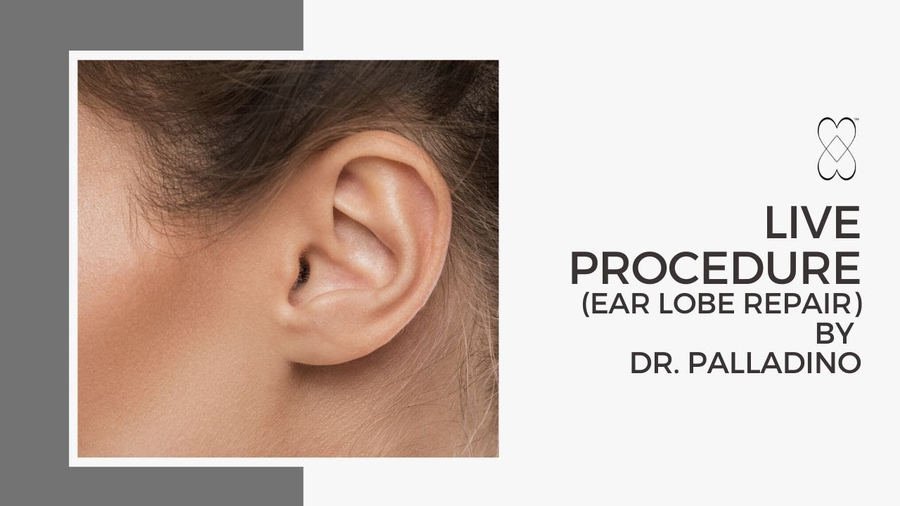 Live Procedure. Ear Lobe Repair - YouTube