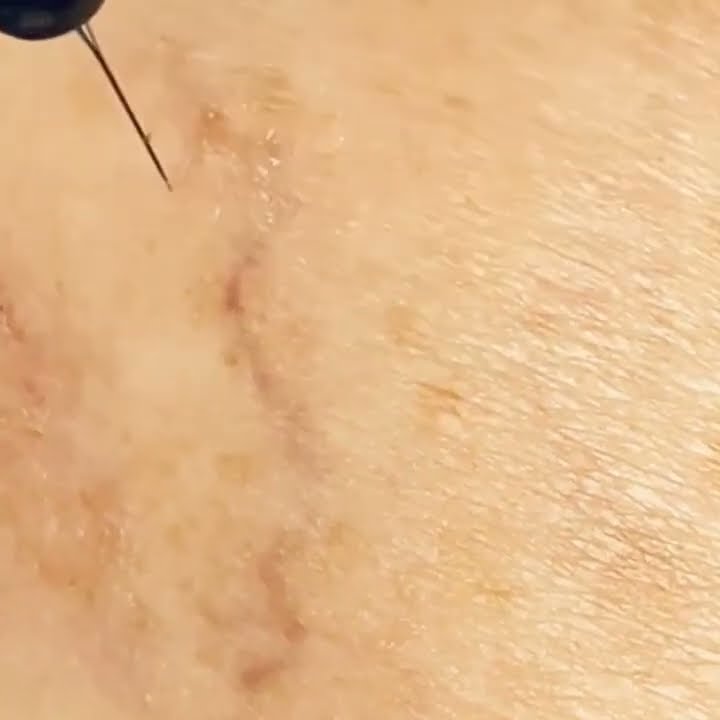 VeinGogh treatment - YouTube