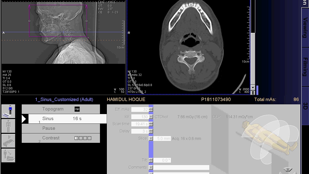 CT scan of sinus techniq - YouTube