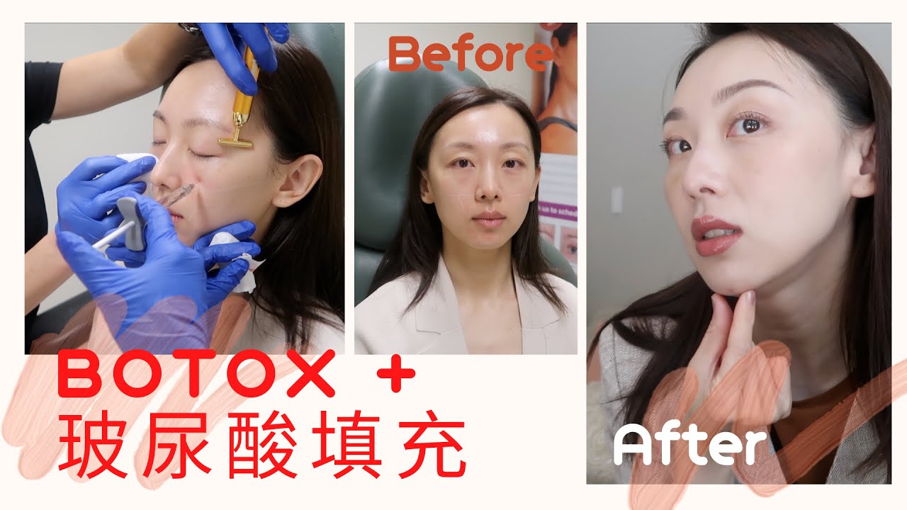 【Anna阿姨 医美vlog#4】肉毒素Botox 玻尿酸乔雅登Filler | 年近四十，终究逃不过这一针 - YouTube