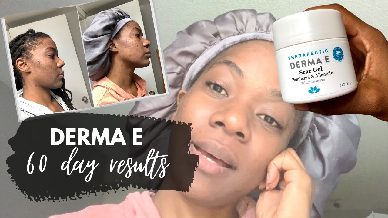 How I Treat My Acne Scars 60 Day Results Using Derma E Scar Gel And