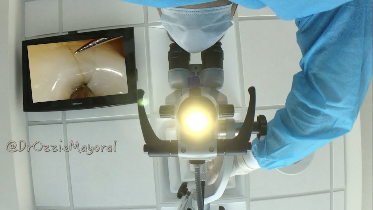 Cracked Tooth Restoration Microscope Dentistry Pinecrest Dental Center ...