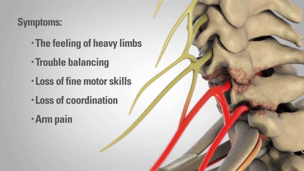 Foraminotomy Vs Laminectomy