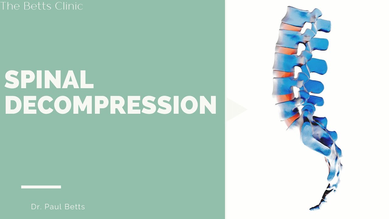 WHAT DO YOU KNOW ABOUT SPINAL DECOMPRESSION? - YouTube