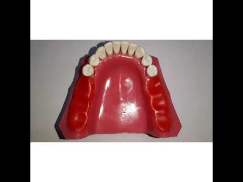 IMPRESSION TECHNIQUES IN REMOVABLE PARTIAL DENTURES - YouTube