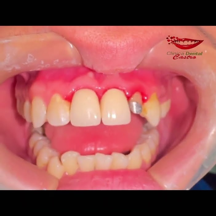 Restos radiculares que aún podamos hacer endodoncia, colocar postes y ...