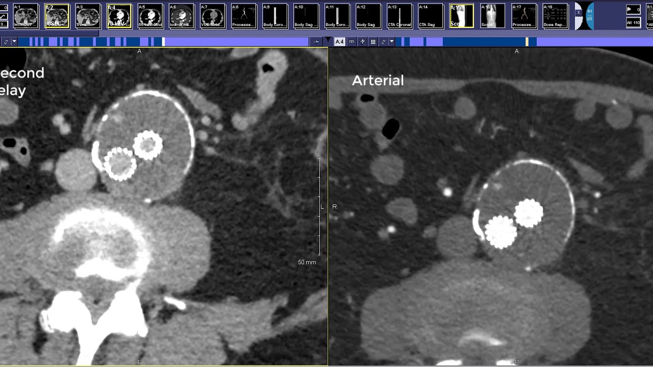 How to read an Endograft CTA - YouTube