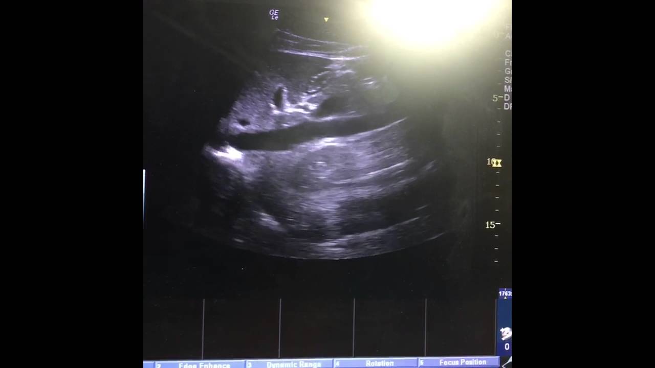 FAST IVC kissing sign - YouTube