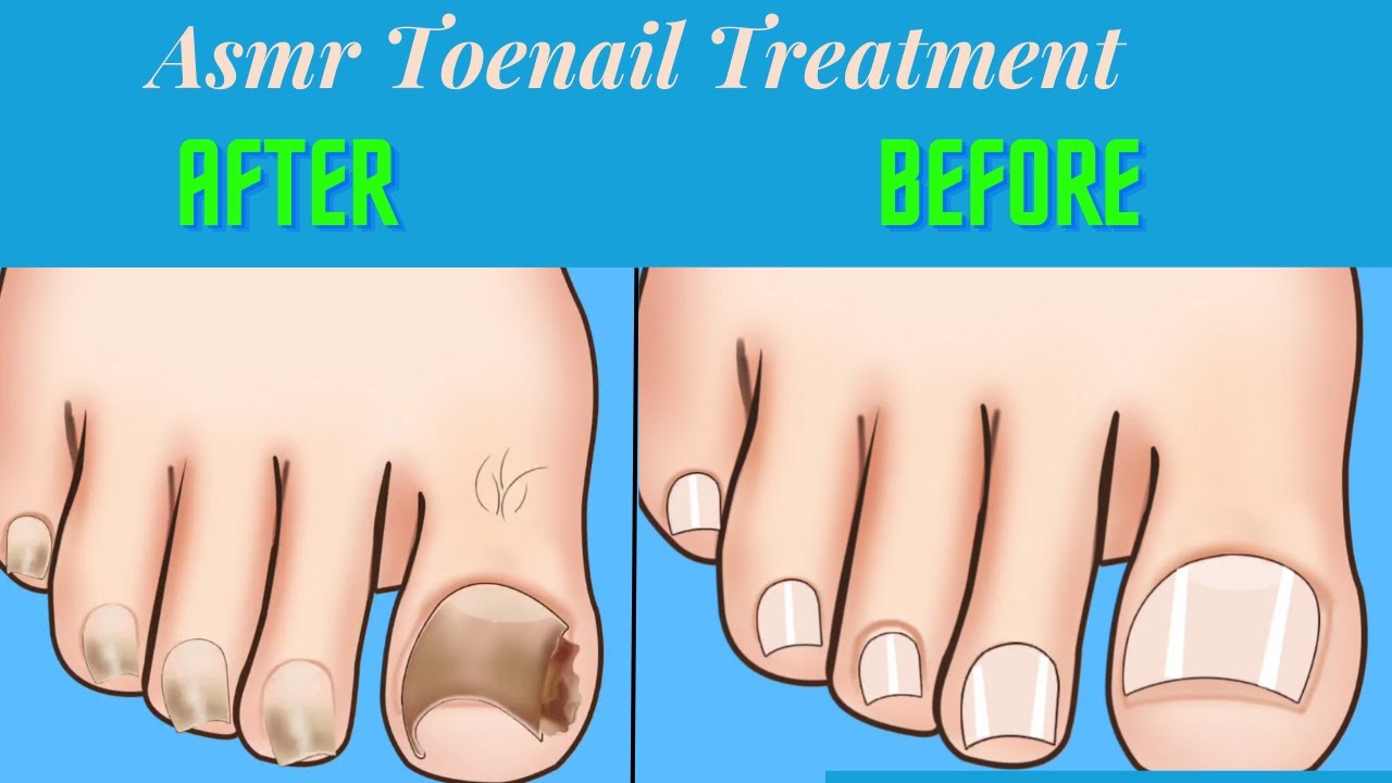 ASMR Ingrown Toenail Removal Treatment Animation Full Video#asmrvideo ...