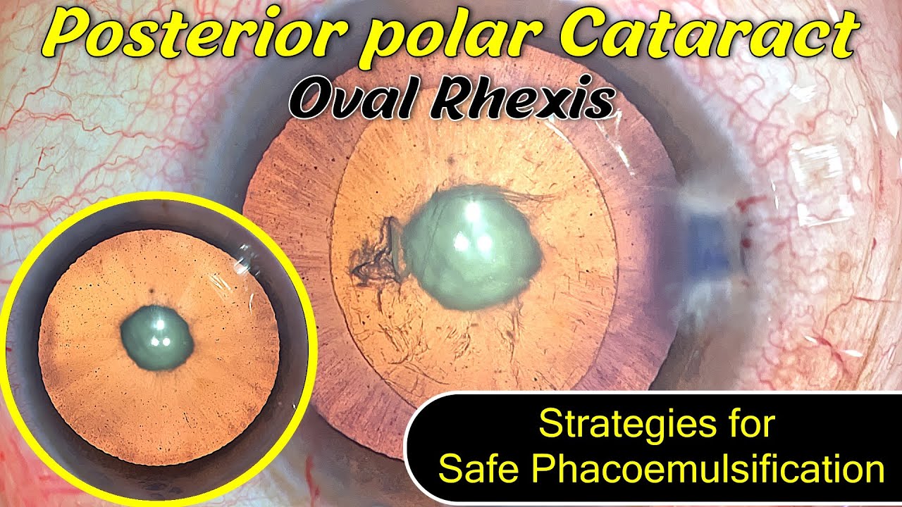 Posterior polar Cataract, Oval Rhexis, Strategies for Safe ...