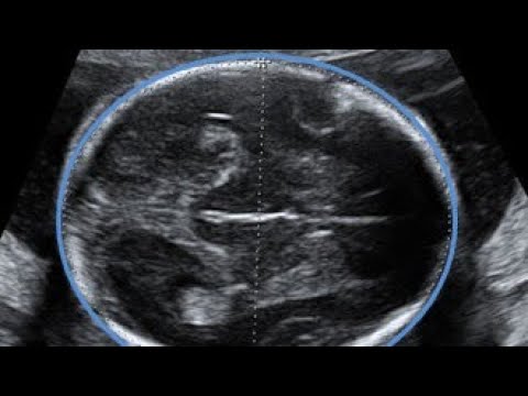 pregnancy ultrasound 33 weeks. #pregnancy #fetus #4dultrasound #4D # ...