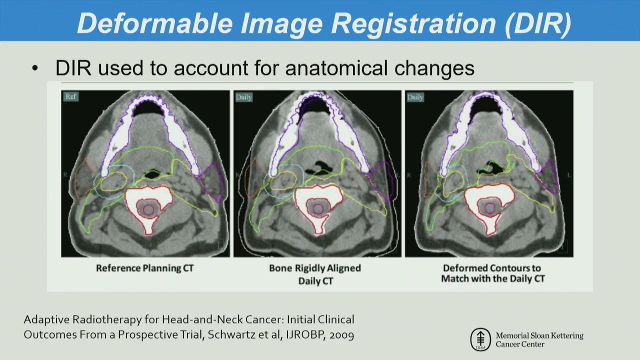 SRS SBRT Treatment Fields Image Regisration Fusion Algorithm And SRS SBRT Treatment Fields Image Regisration Fusion Algorithm And