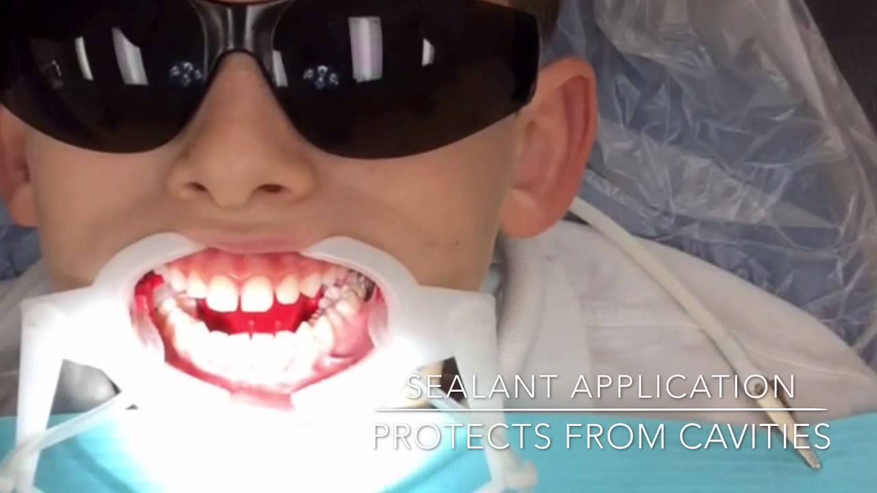 How to place braces at Clark Orthodontics - YouTube
