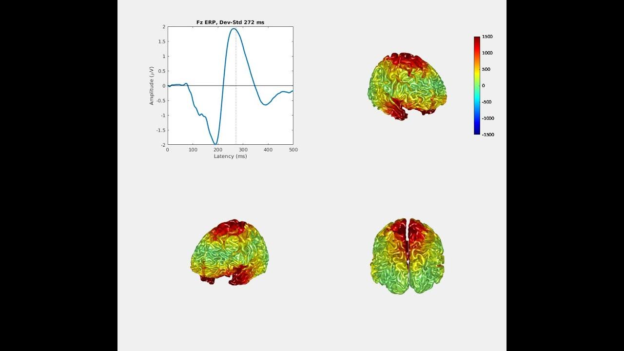 eLORETA demo on auditory mismatch negativity ERP (n=307) - YouTube