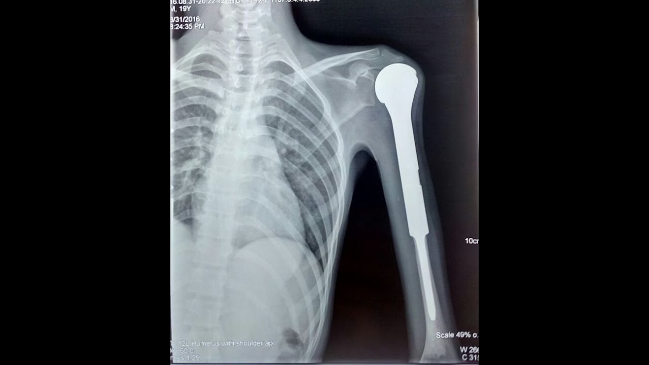 Surgical Demo of Tumour Resection and Endoprosthesis for Ewings Sarcoma ...