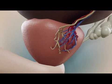 Chirurgie assistée par Robot pour cancer de prostate