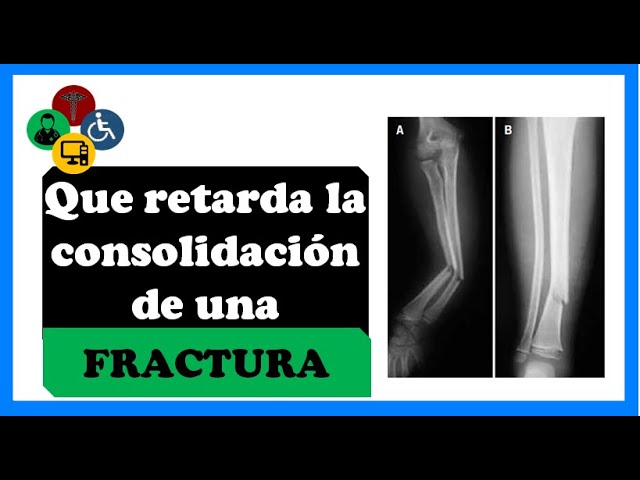 Cuanto Tarda En Sanar Una Fisura De Hueso Discount | smarys.org Cuanto Tarda En Sanar Una Fisura De Hueso Discount | smarys.org