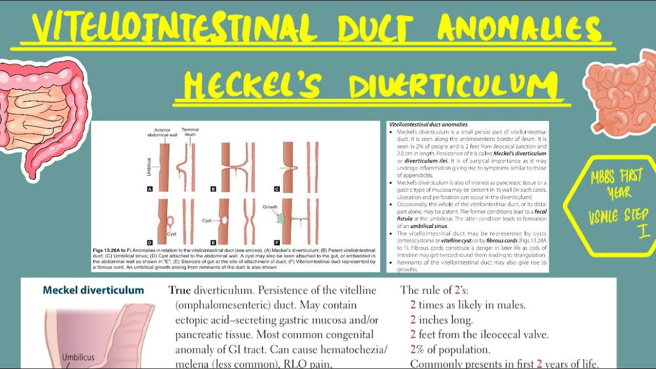 👶Meckel’s Diverticulum | GIT MBBS EMBRYOLOGY | USMLE Step 1 - YouTube