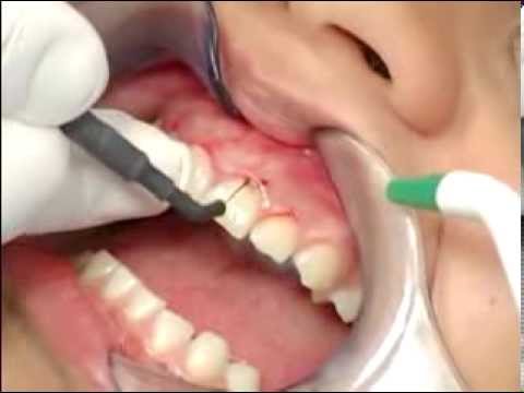 Electrobisturí PerFect TCSII - YouTube