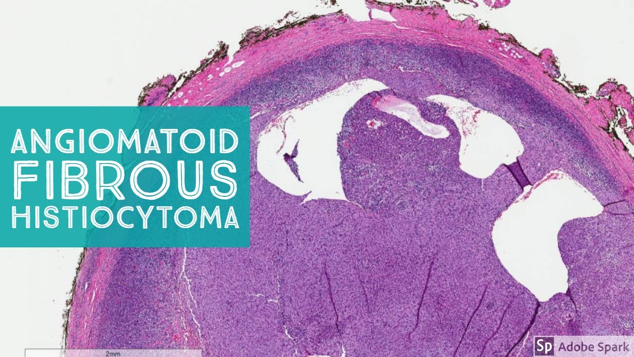 Angiomatoid Fibrous Histiocytoma 101 (Note: it's NOT aneurysmal ...