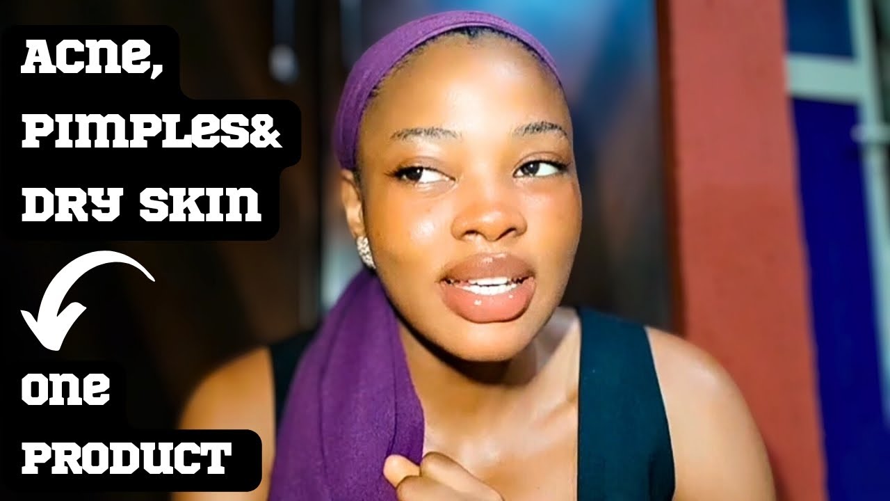 Rhome Soap Honest Review for Dark Spots, Acne, Pimples - YouTube