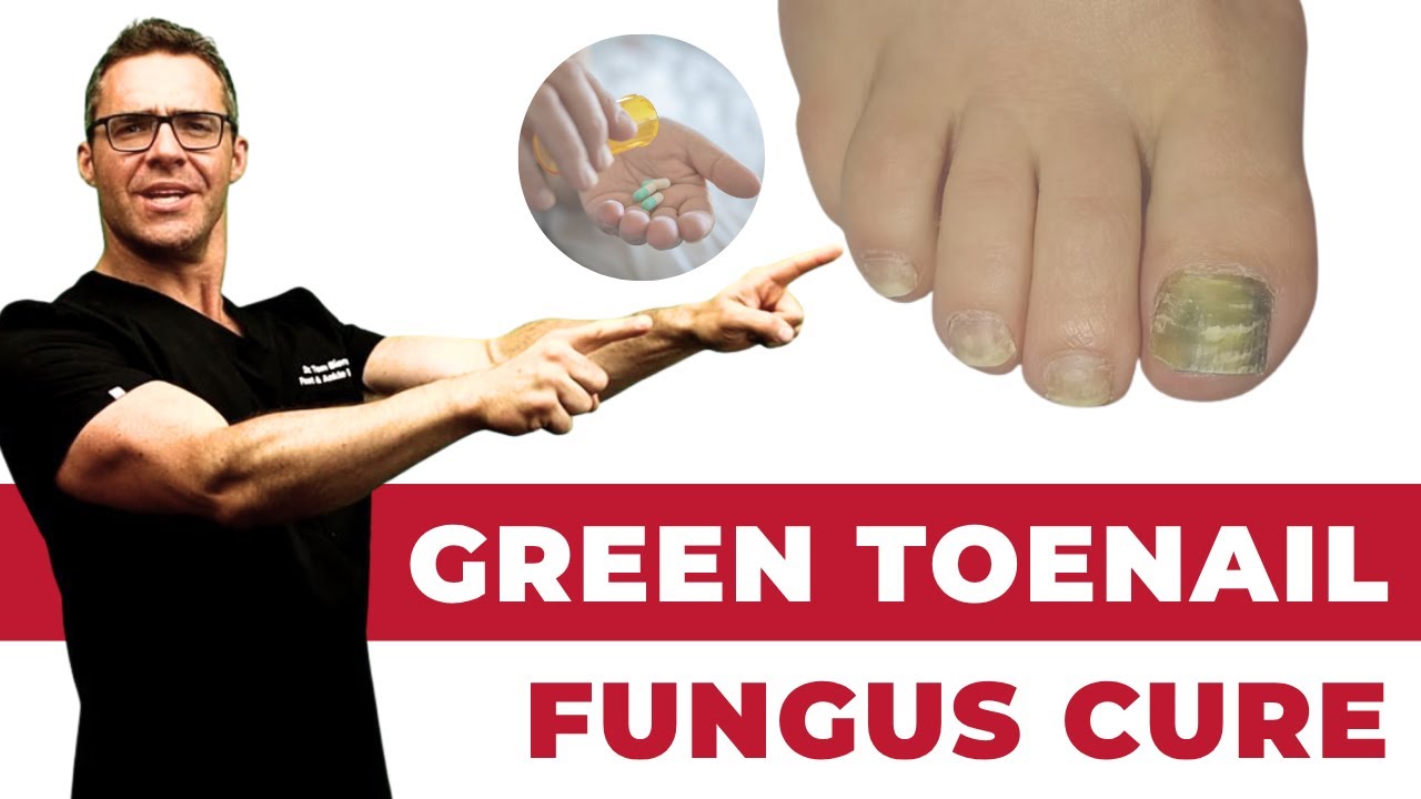 Green Toenail Fungus Cure [Home Treatment Guide!] - YouTube