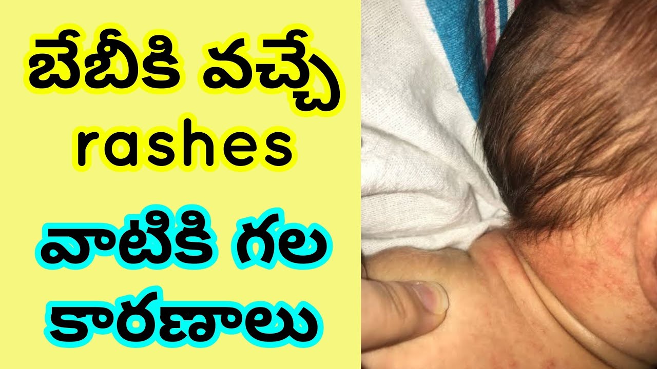 Baby rashes / reasons of baby rash / prevention of baby rash / baby ...