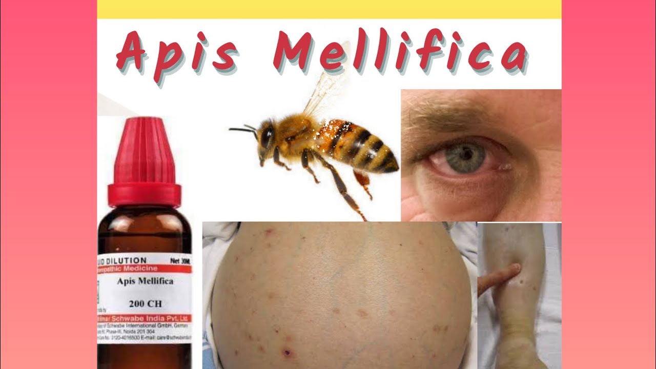 ||Apis Mellifica|| ||Allen's keynote|| ||Homoeopathic drug|| ||BHMS ...