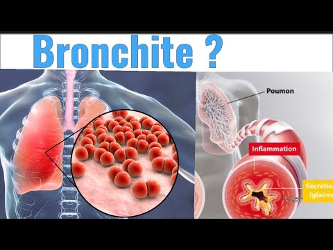 Bronchite Tout savoir @santeDivertissement #infection - YouTube