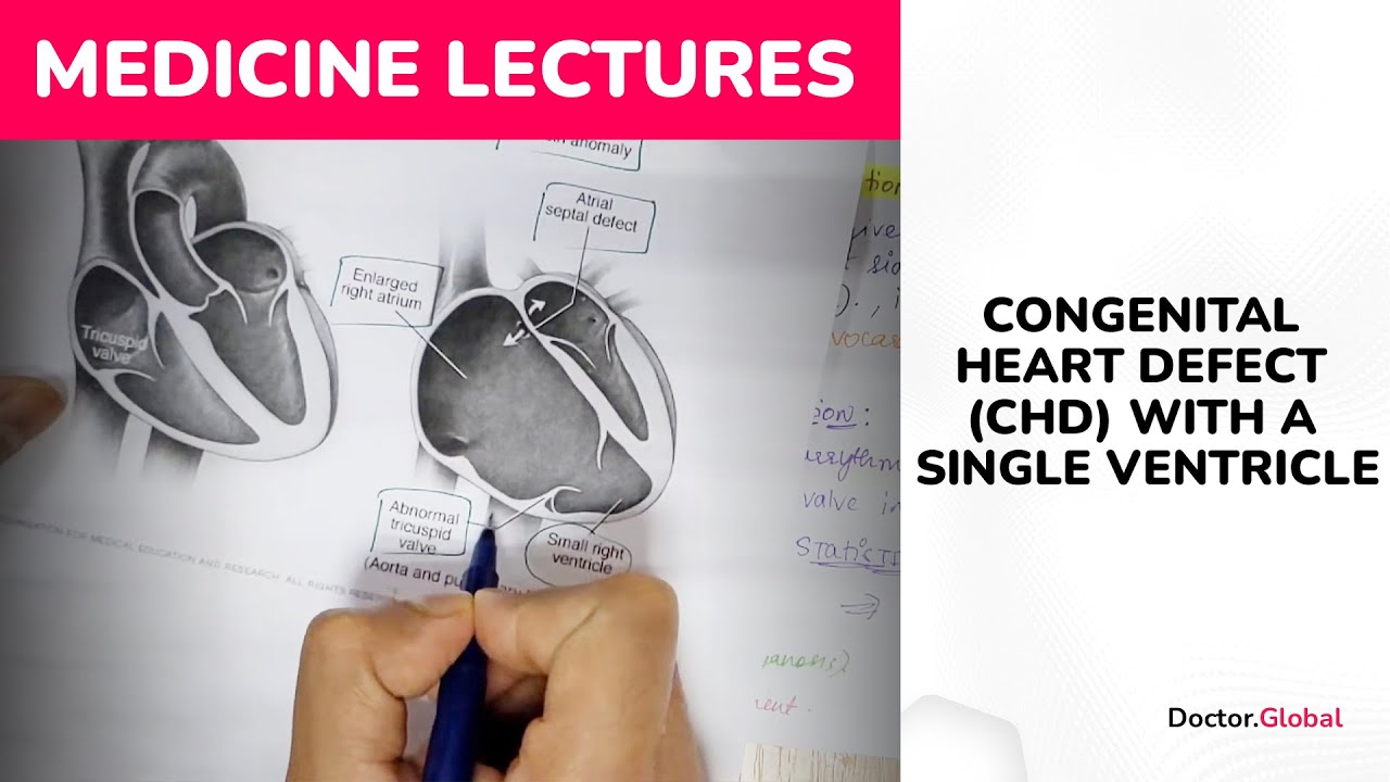 Congenital Heart Defect (CHD) With a Single Ventricle - YouTube
