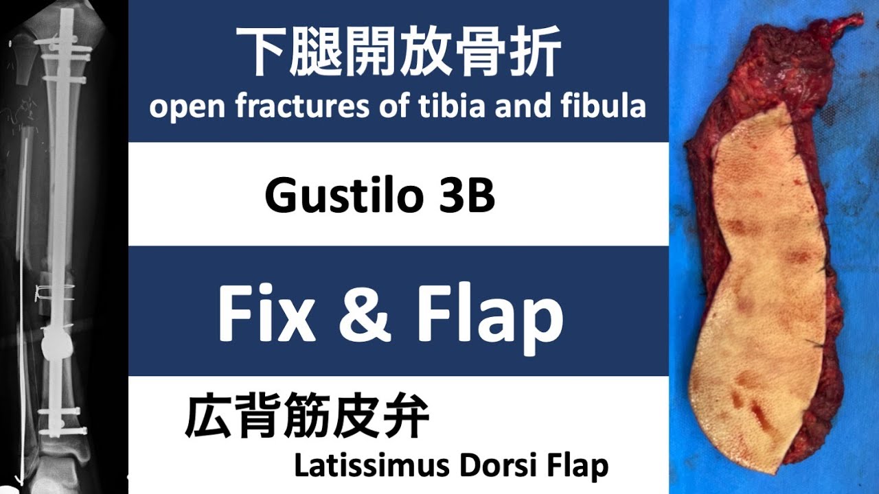 Fix & Flap for tibia and fibula open fractures (One artery limb)【Lower ...