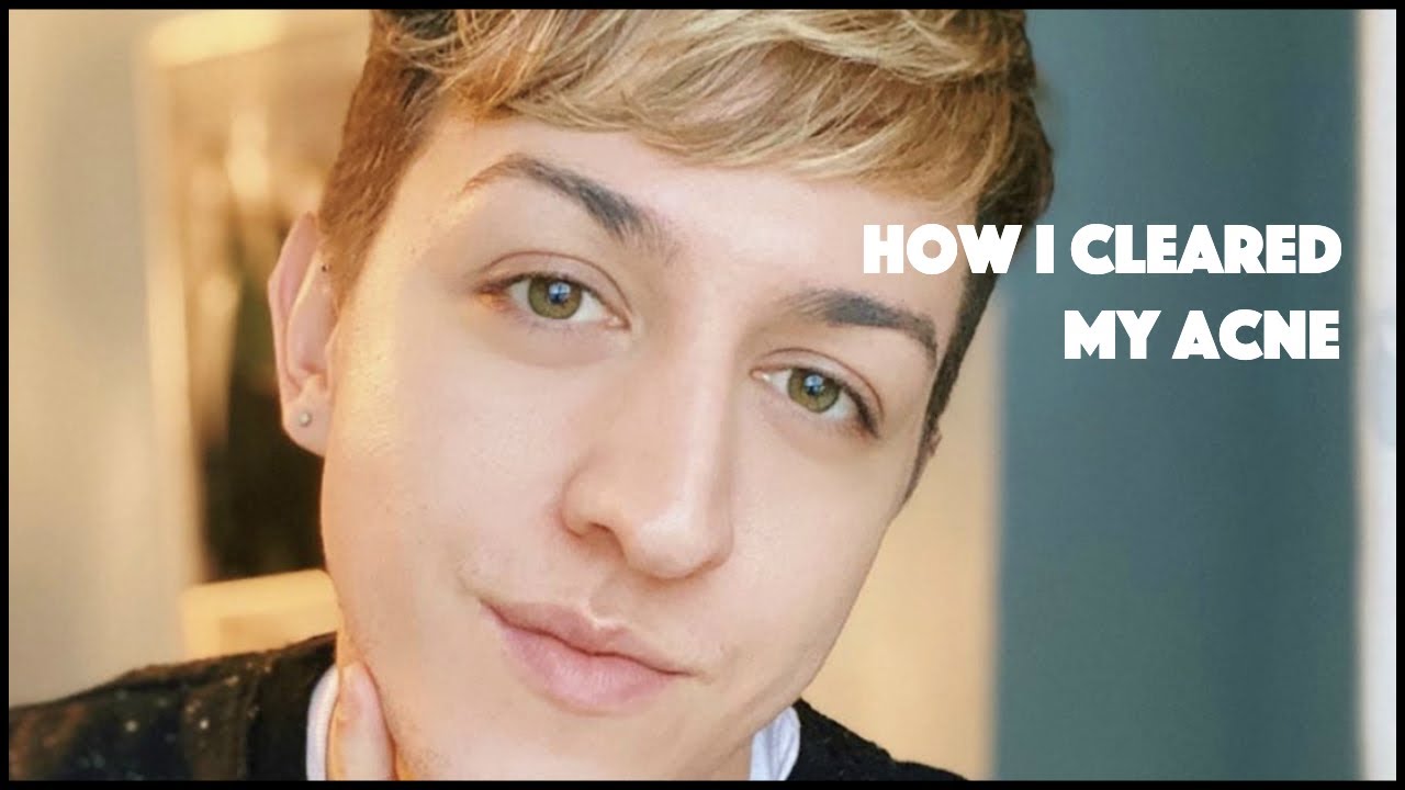 HOW I CLEARED MY ACNE - PRODUCTS AND TIPS || MAX'S LOOK - YouTube