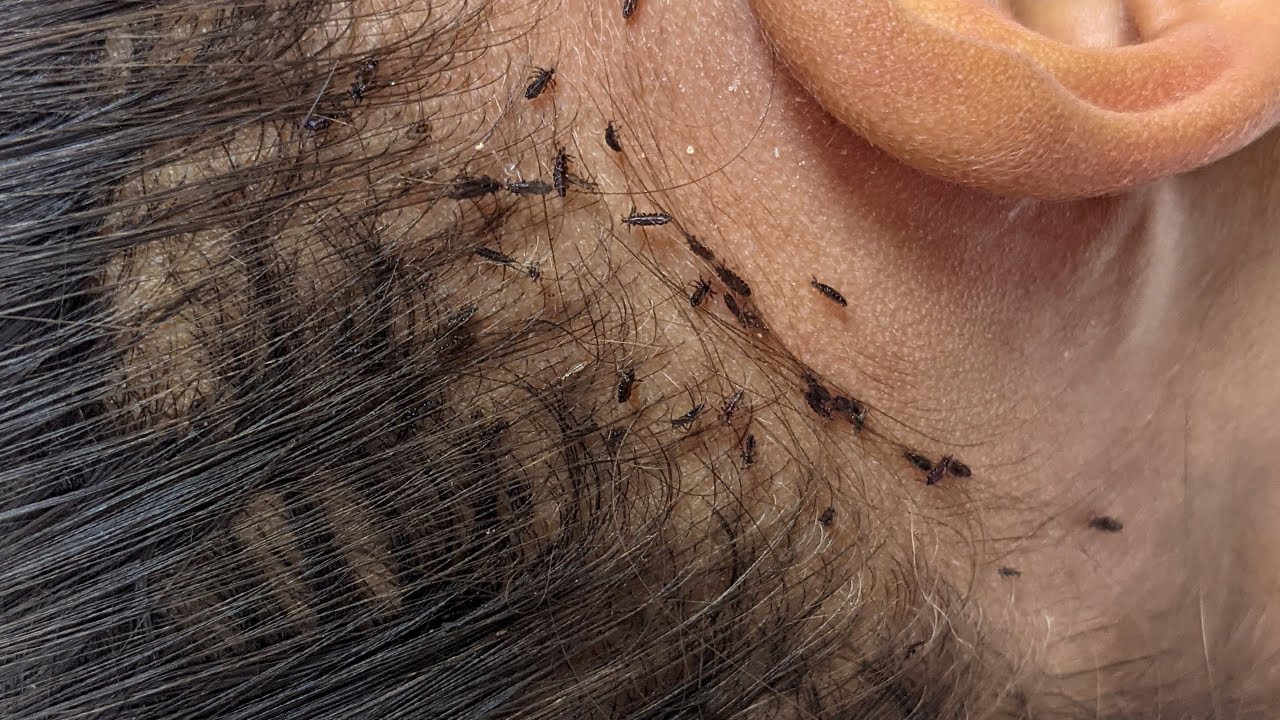 Picking Out All Lice From Sister Head - Remove So Many Lice From Black ...