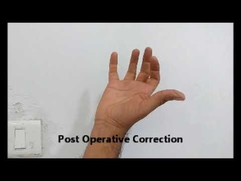 Malunited Fracture with Finger Overlapping - YouTube
