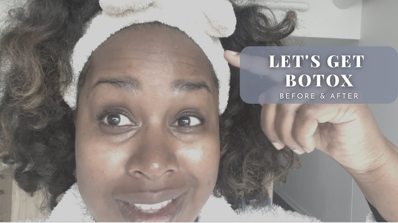 I GOT BOTOX 💉| Before & After | Baby Botox - YouTube