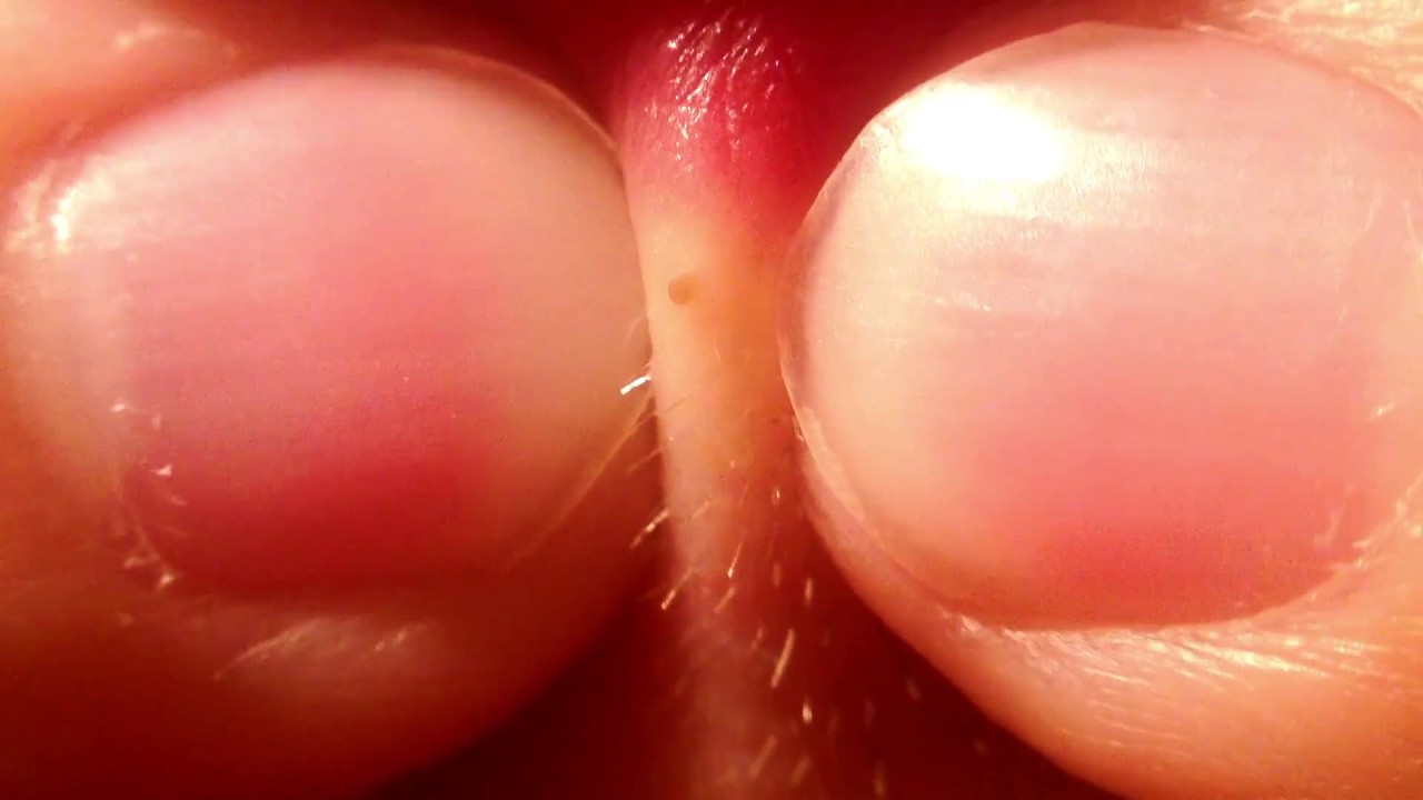 Lip Blackhead Removal YouTube lip-blackhead-removal-youtube