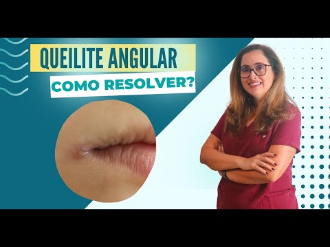 Queilite angular, a boqueira. Como resolver? | Adornare Odontologia ...